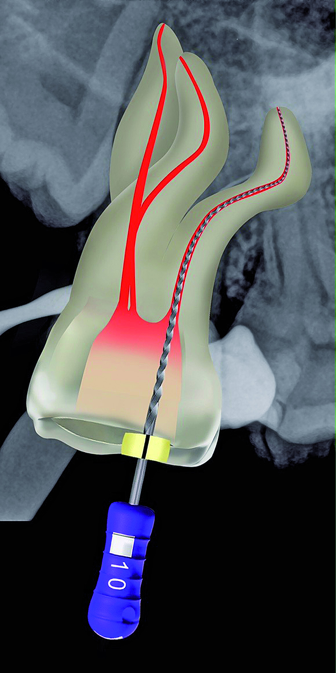 Dental News - 3D Endo Software, glide path management and WaveOne Gold