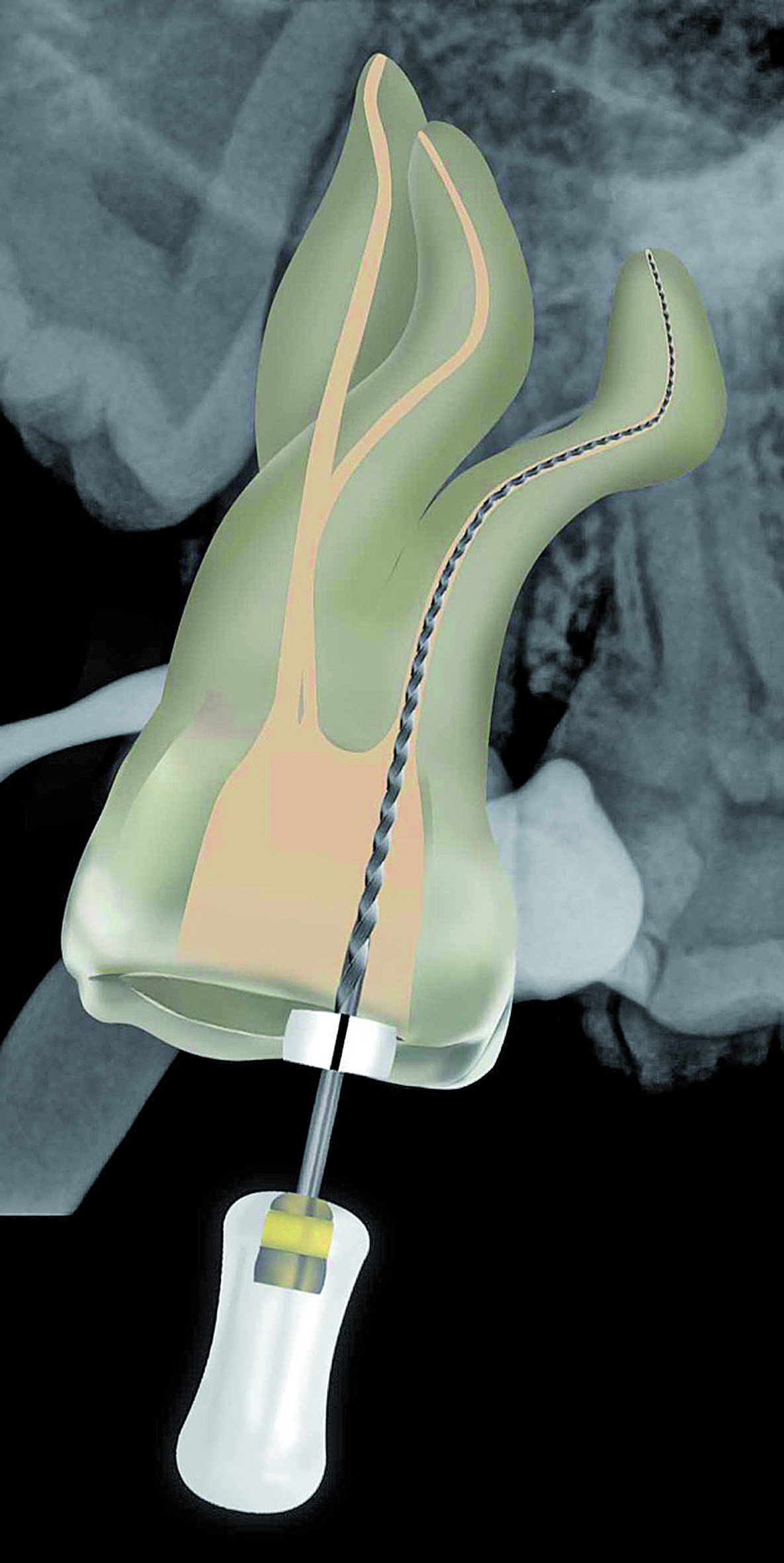 Dental News - 3D Endo Software, glide path management and WaveOne Gold