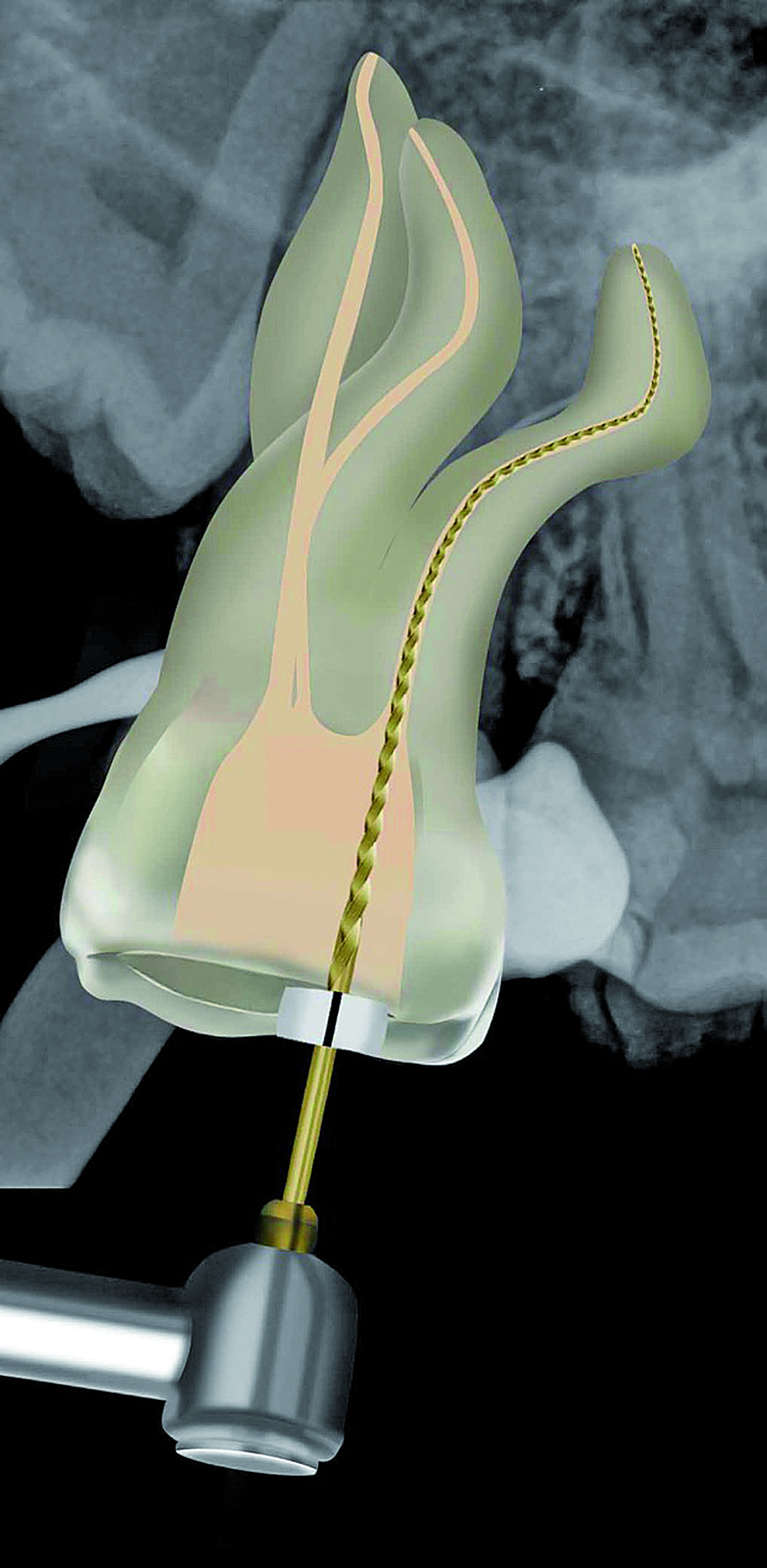 Dental News - 3D Endo Software, glide path management and WaveOne Gold
