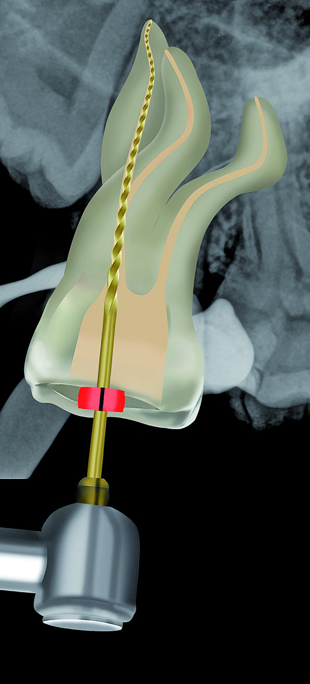 Dental News - 3D Endo Software, glide path management and WaveOne Gold