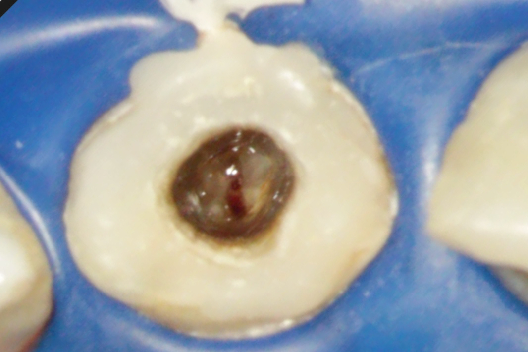 Dental News - MTA placement with the Produits Dentaires MAP System