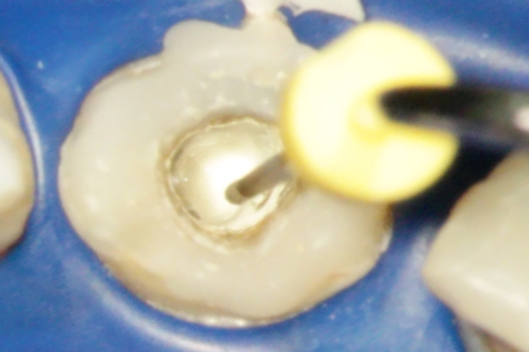 Dental News - MTA placement with the Produits Dentaires MAP System