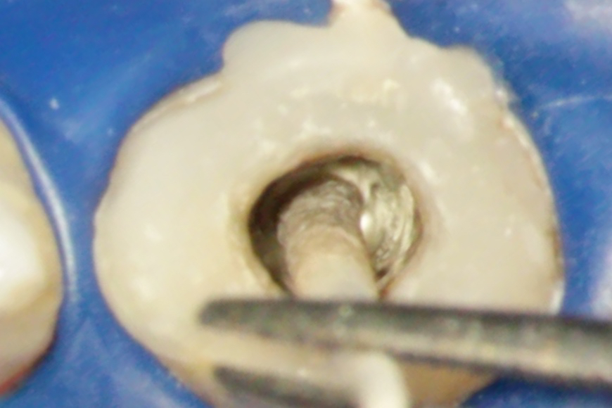 Dental News - MTA placement with the Produits Dentaires MAP System