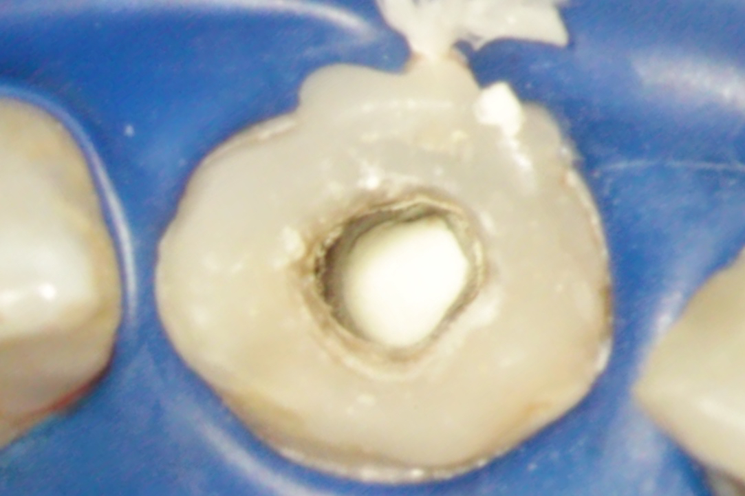 Dental News - MTA placement with the Produits Dentaires MAP System