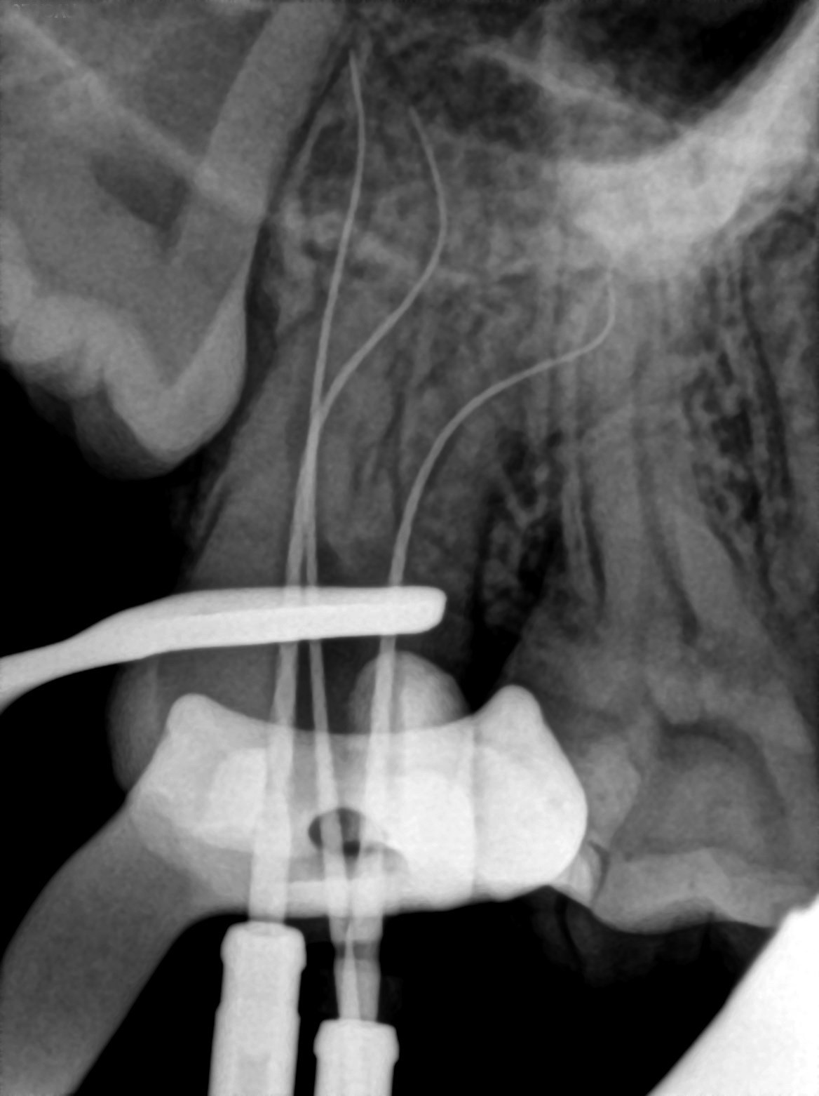 Dental News - 3D Endo Software, glide path management and WaveOne Gold