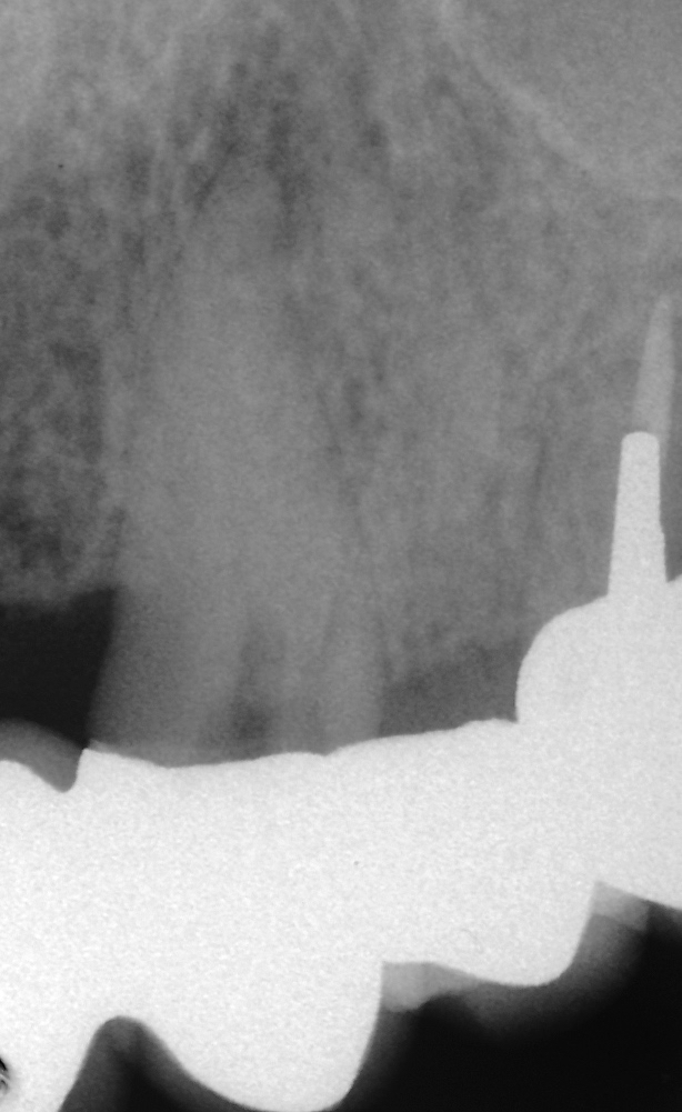 Dental News - MTA placement with the Produits Dentaires MAP System