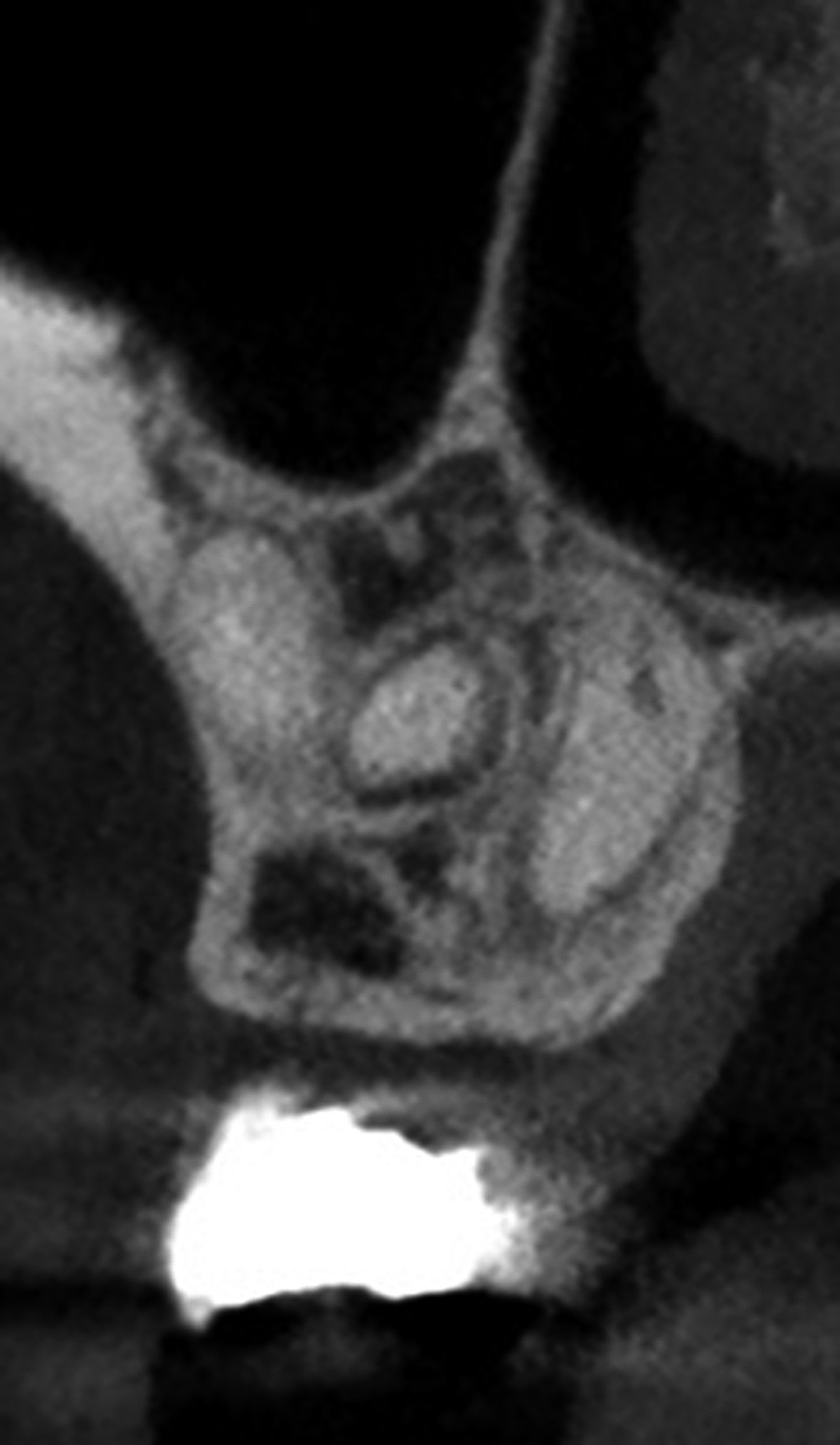 Dental News - 3D Endo Software, glide path management and WaveOne Gold