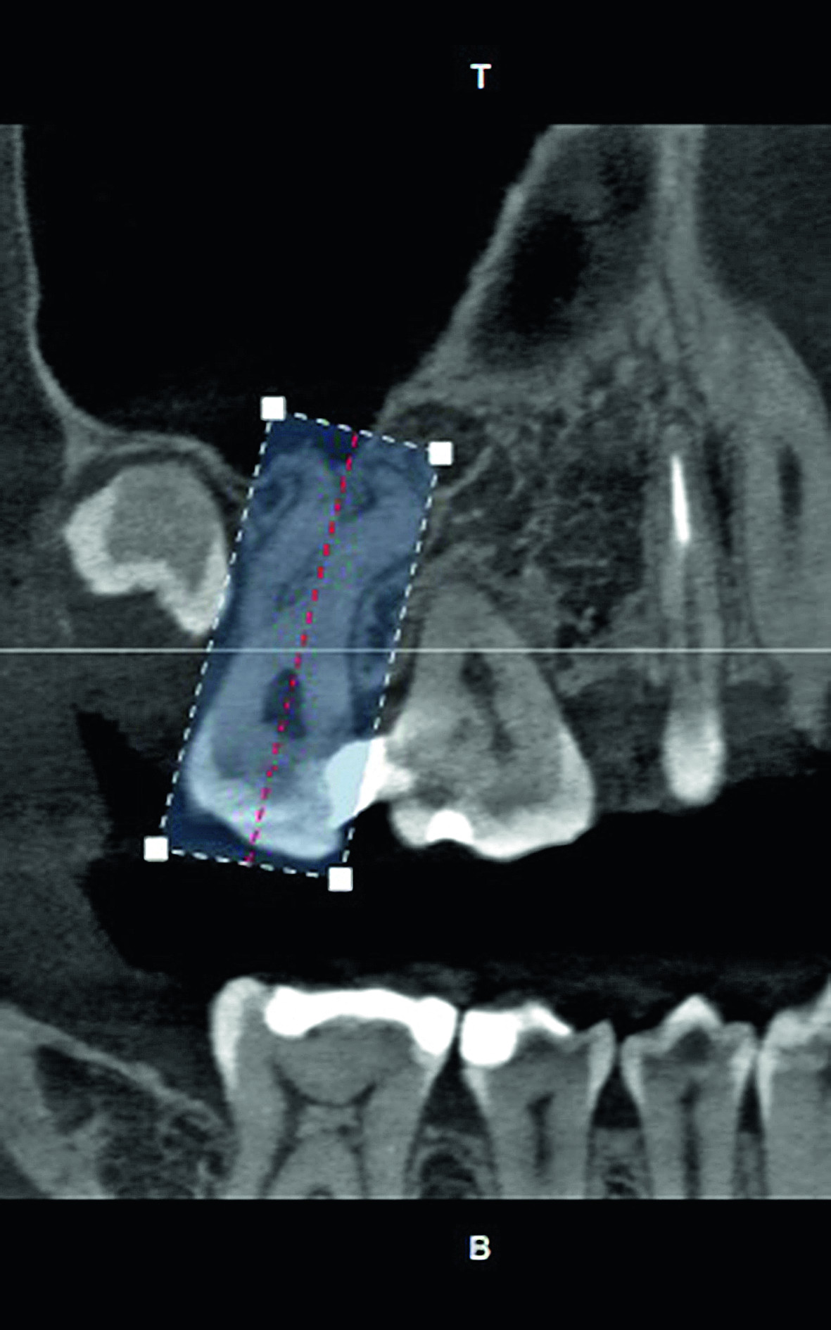 Dental News - 3D Endo Software, glide path management and WaveOne Gold