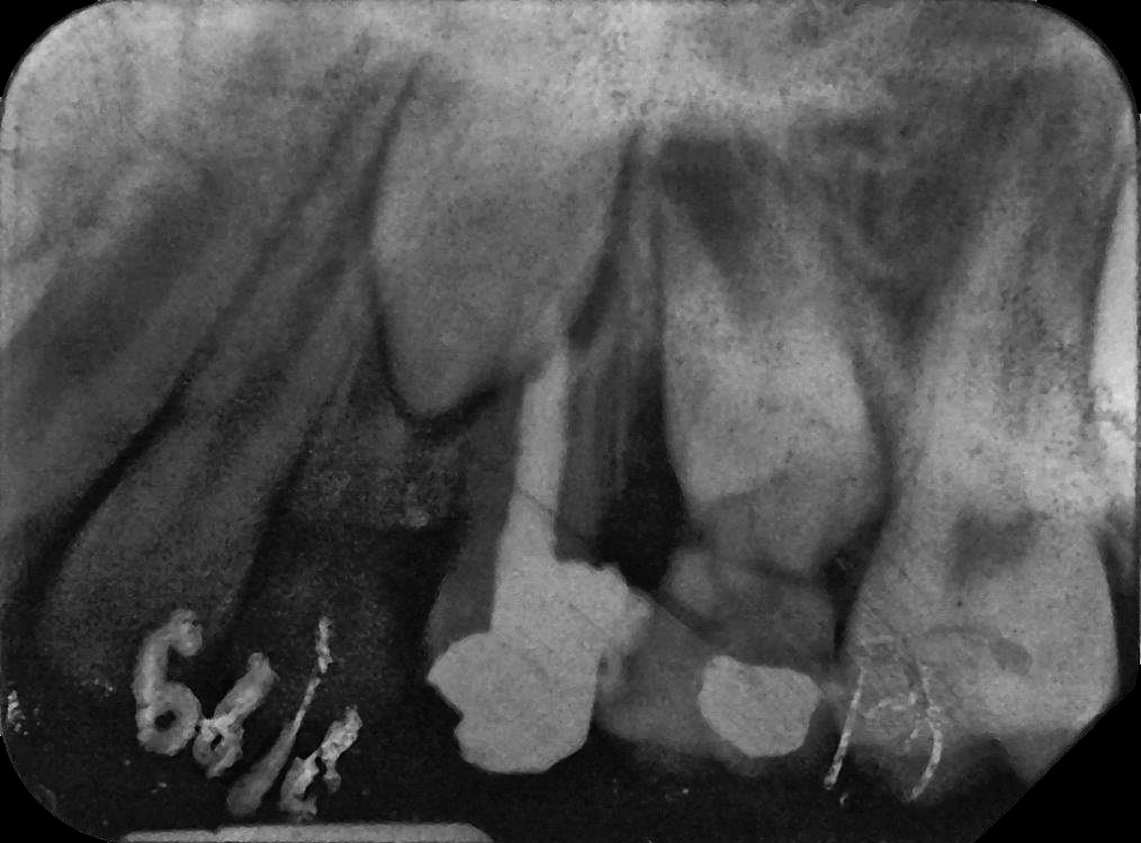Dental News - Success evaluation of N2 treated teeth with open apical ...