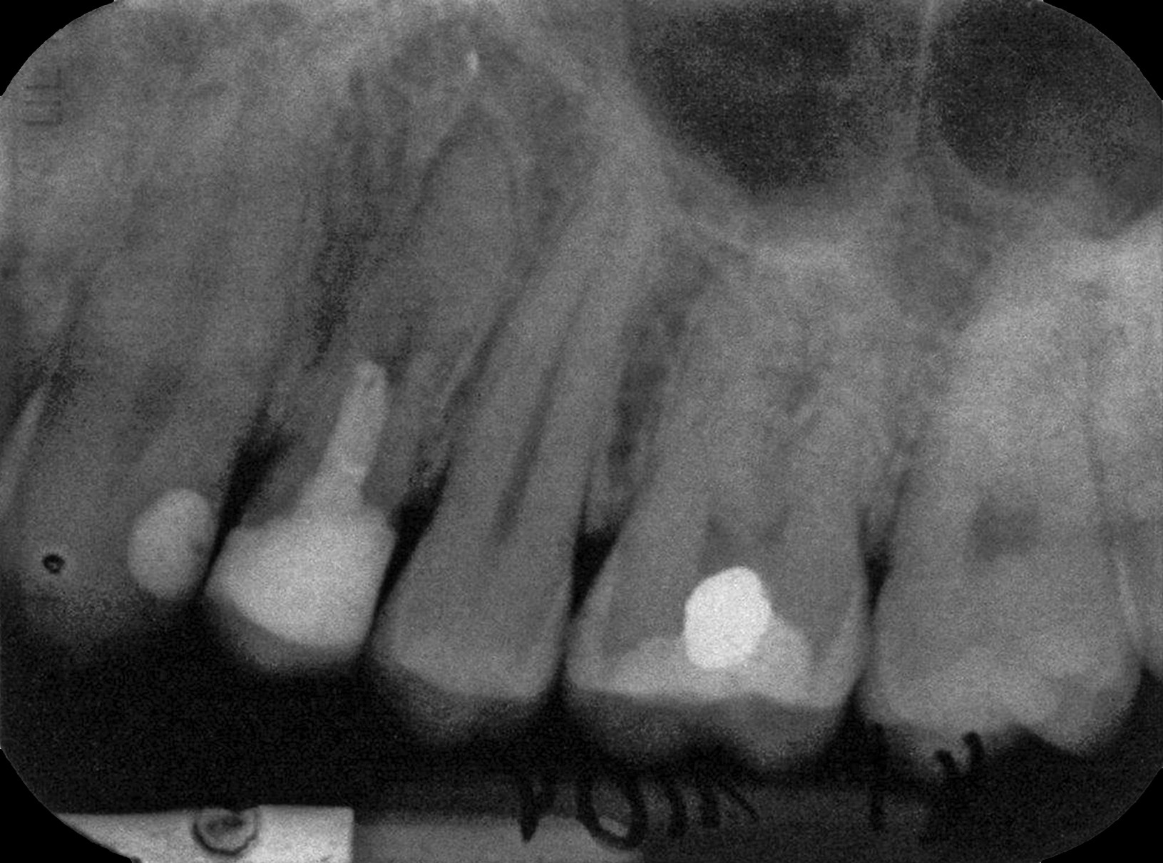 Dental News - Success evaluation of N2 treated teeth with open apical ...
