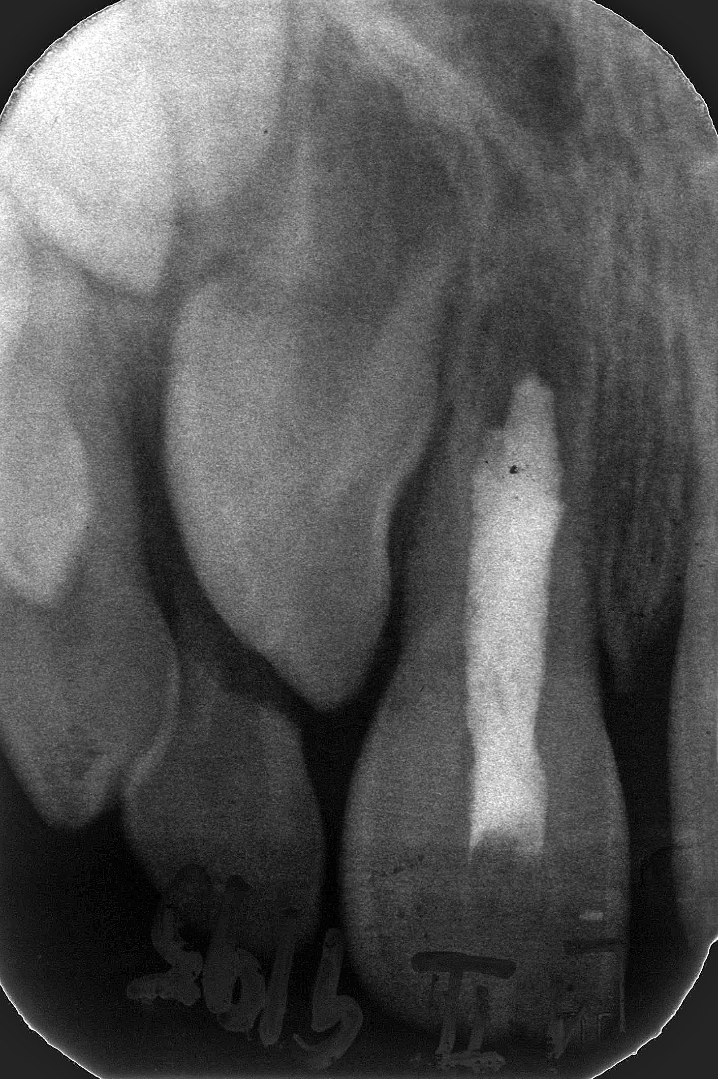 Dental News - Success evaluation of N2 treated teeth with open apical ...