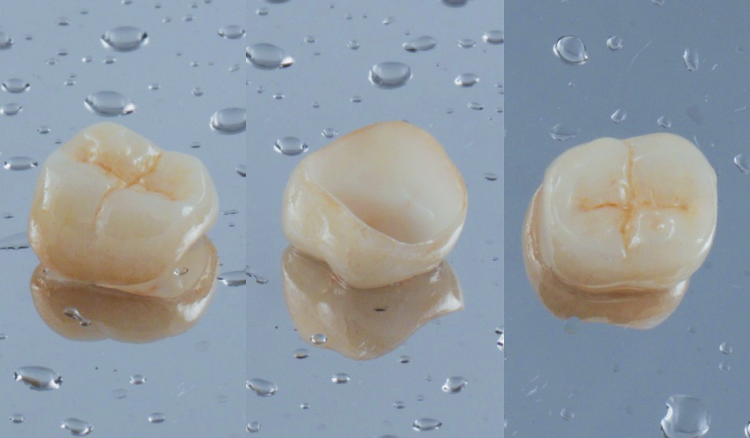 3M™ RelyX™ Ultimate Adhesive Resin Cement – Posterior Crown