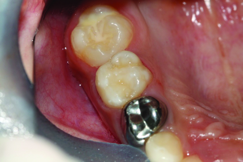 DT News - MEA - Management Of Ectopically Erupted First Permanent Molars