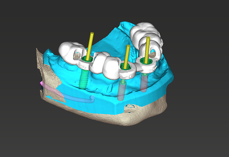 Dental Wings – coDiagnostiX Implant Planning Software