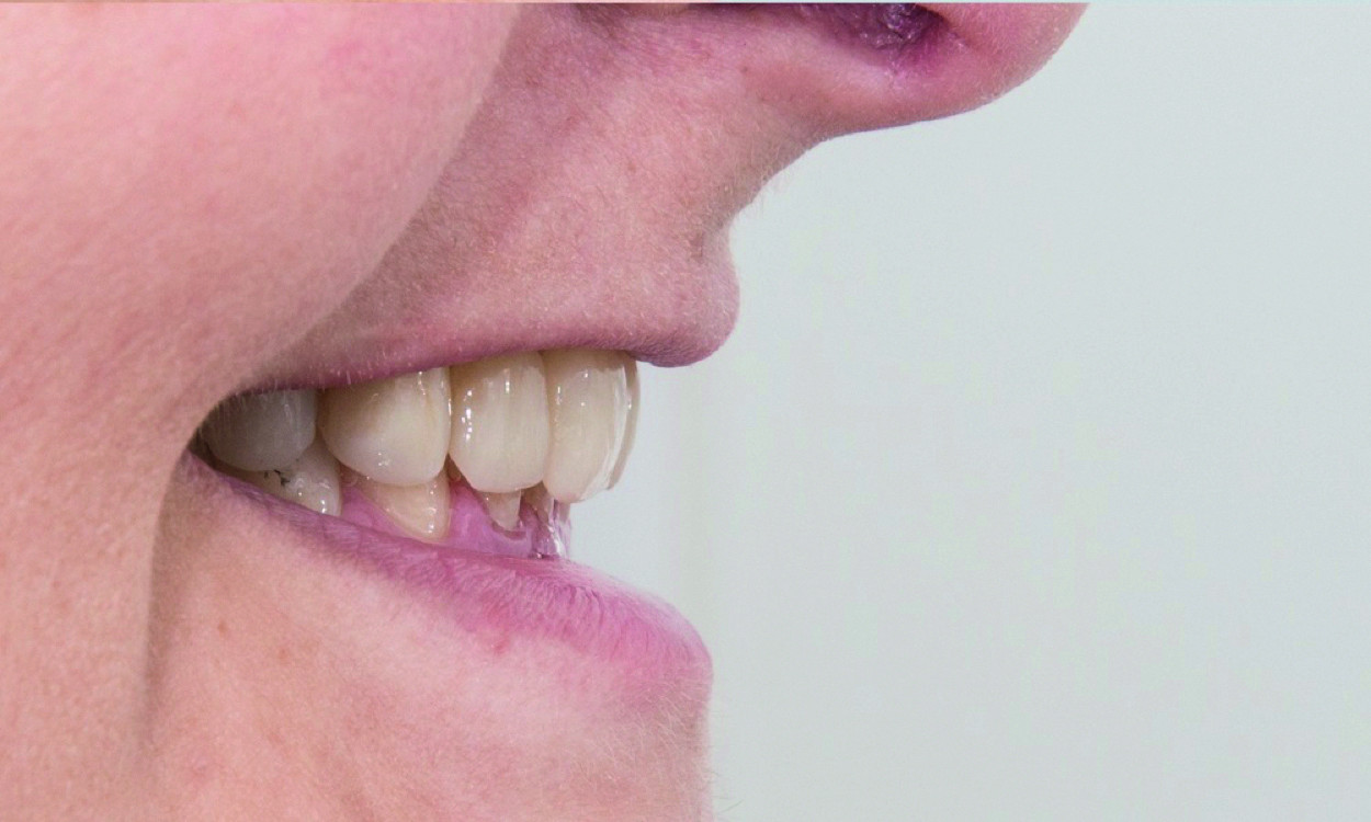 Dental News - Combined CAD/CAM-assisted treatment, for a new, beautiful ...