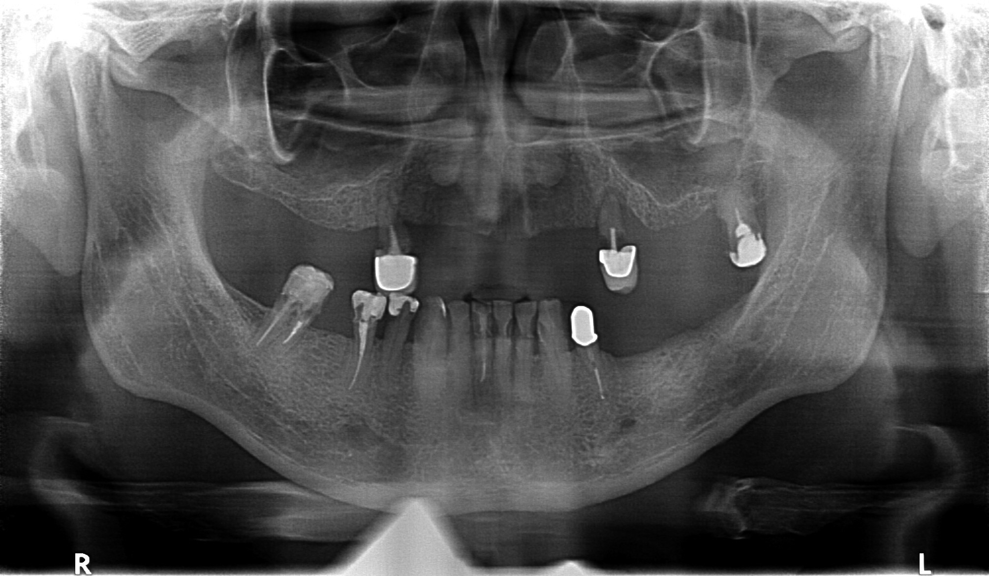 Dental News - The use of CBCT and CAD/CAM techniques in implant ...