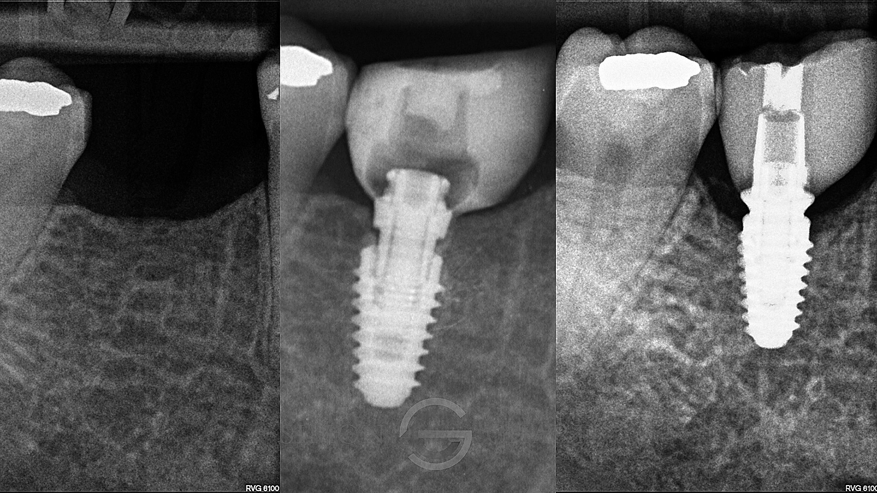 Dental News - Implant restoration with CEREC