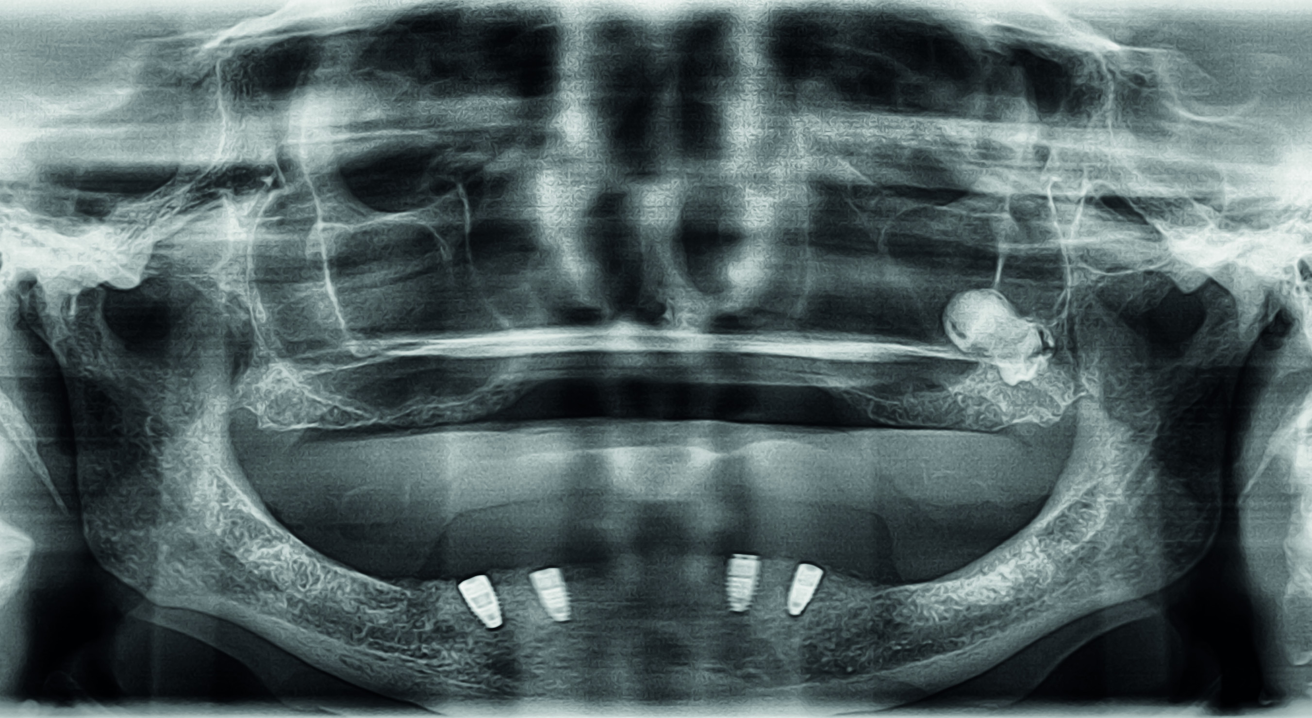 Dental News - Dynamic navigation for reliable and predictable flapless ...