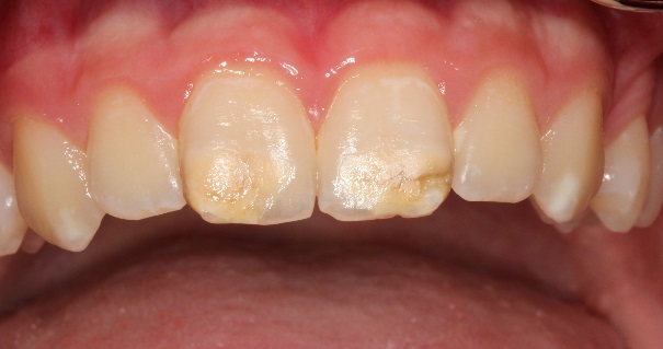 Dental News - Prevalence of MIH exceeds that of dental caries among ...