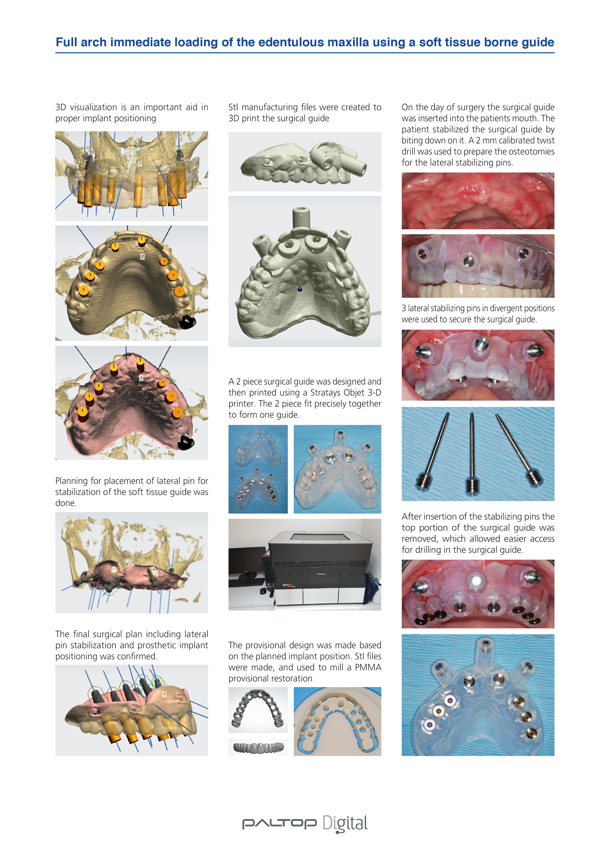 Full arch immediate loading of the edentulous maxilla using a soft ...
