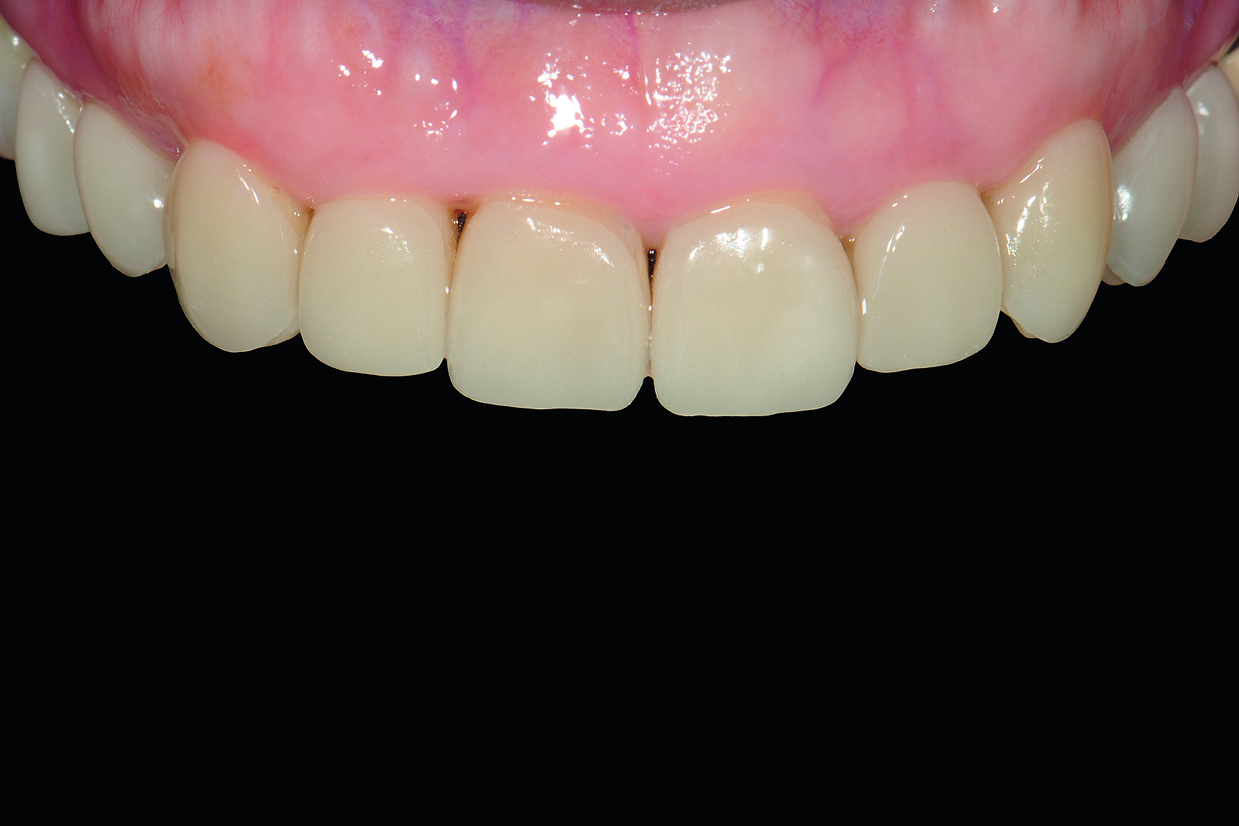 Dental News - Chairside CAD/CAM immediate restorations