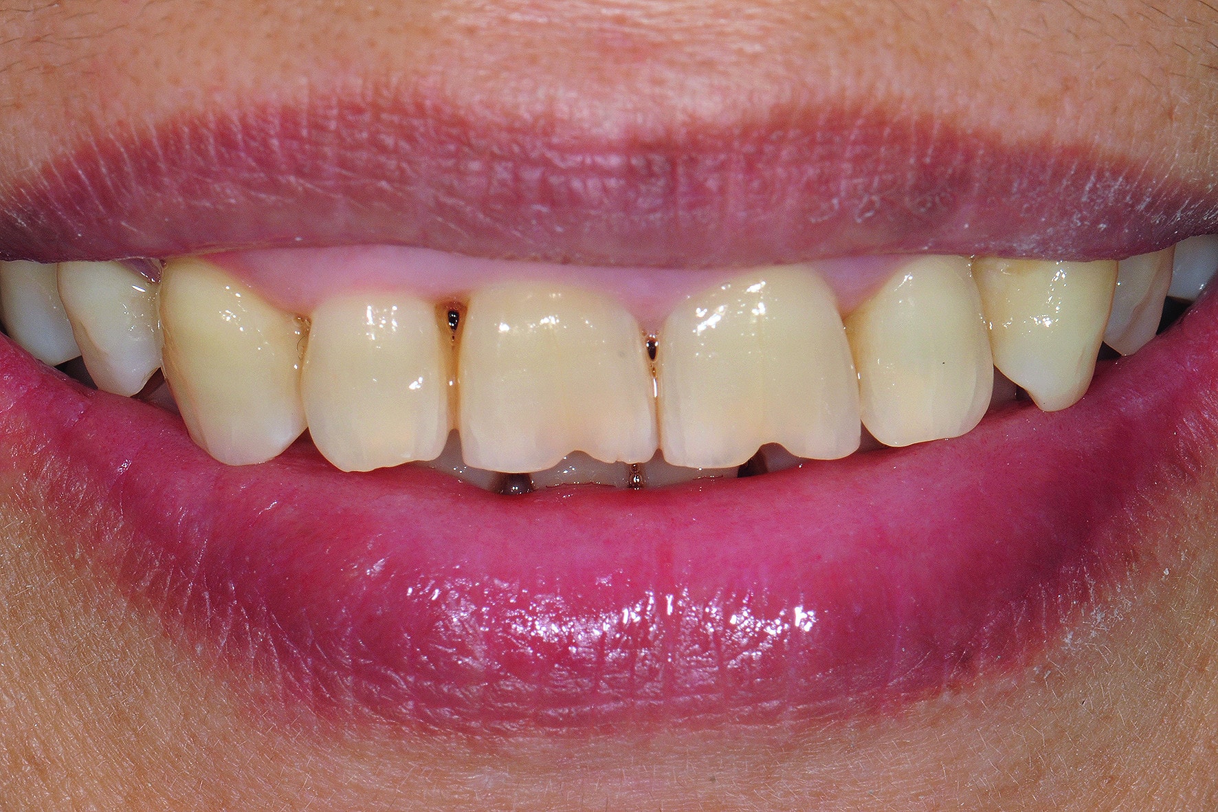 Dental News - Chairside CAD/CAM immediate restorations