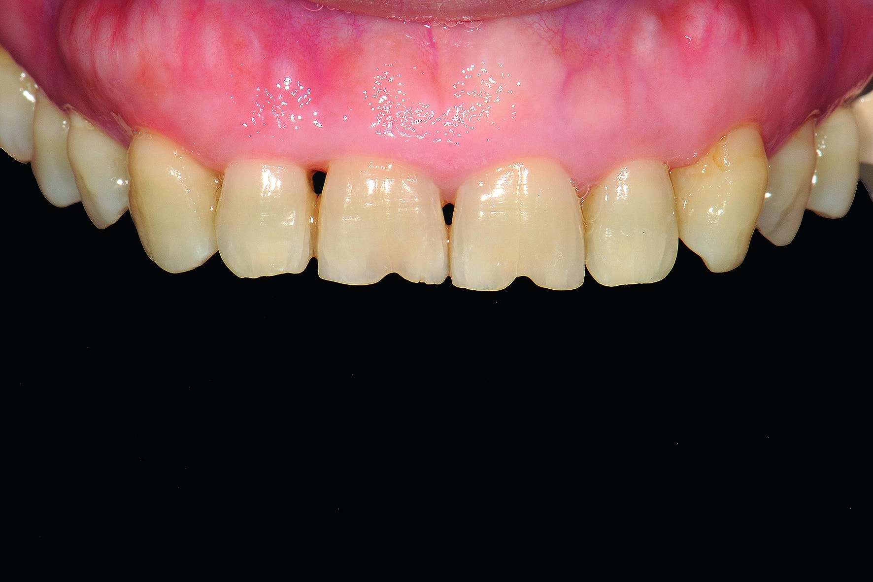 Dental News - Chairside CAD/CAM immediate restorations