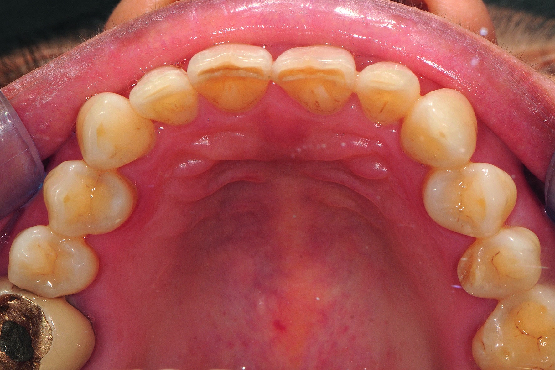 Dental News - Chairside CAD/CAM immediate restorations