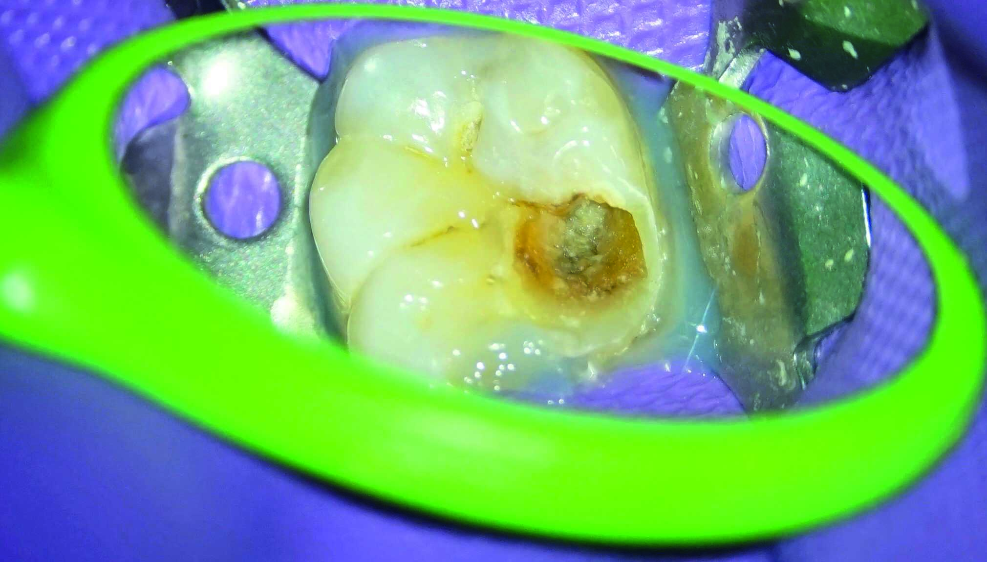 Dental News - Direct pulp capping as a conservative procedure to ...