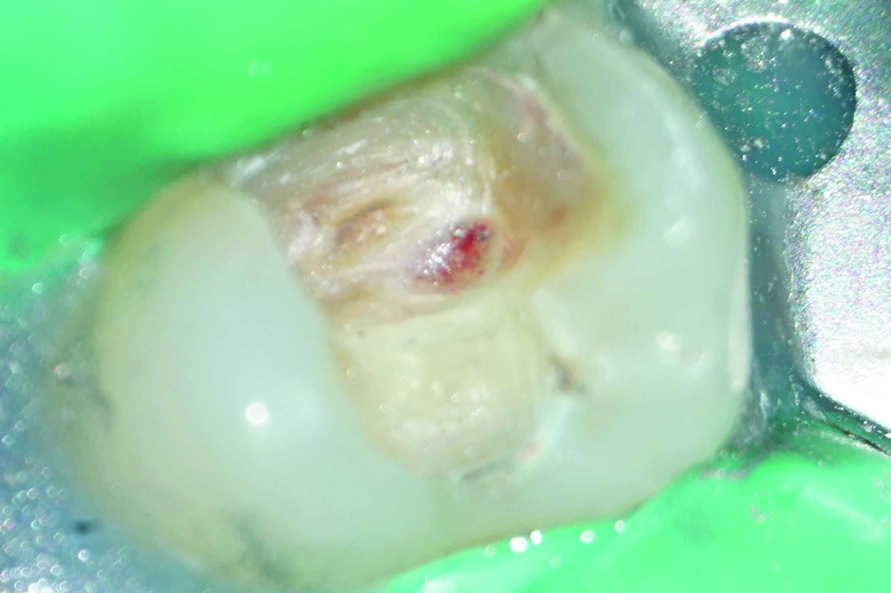 Dental News - Direct pulp capping as a conservative procedure to ...