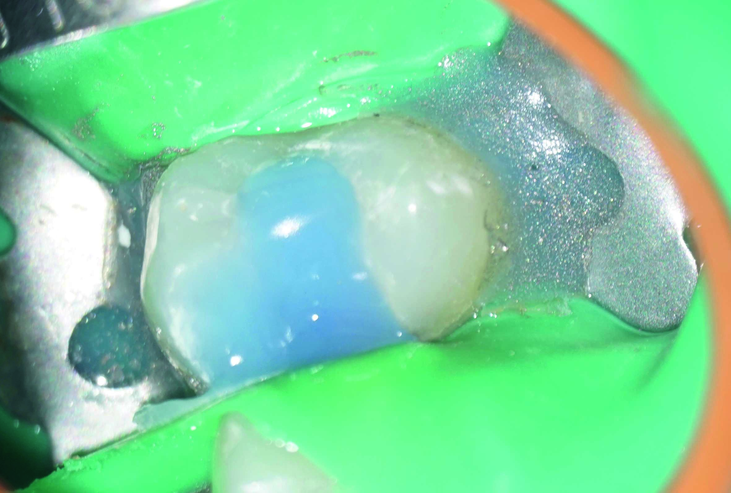 Dental News - Direct pulp capping as a conservative procedure to ...