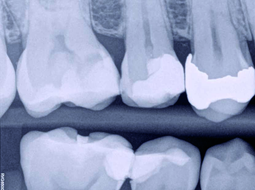 Dental News - Direct pulp capping as a conservative procedure to ...