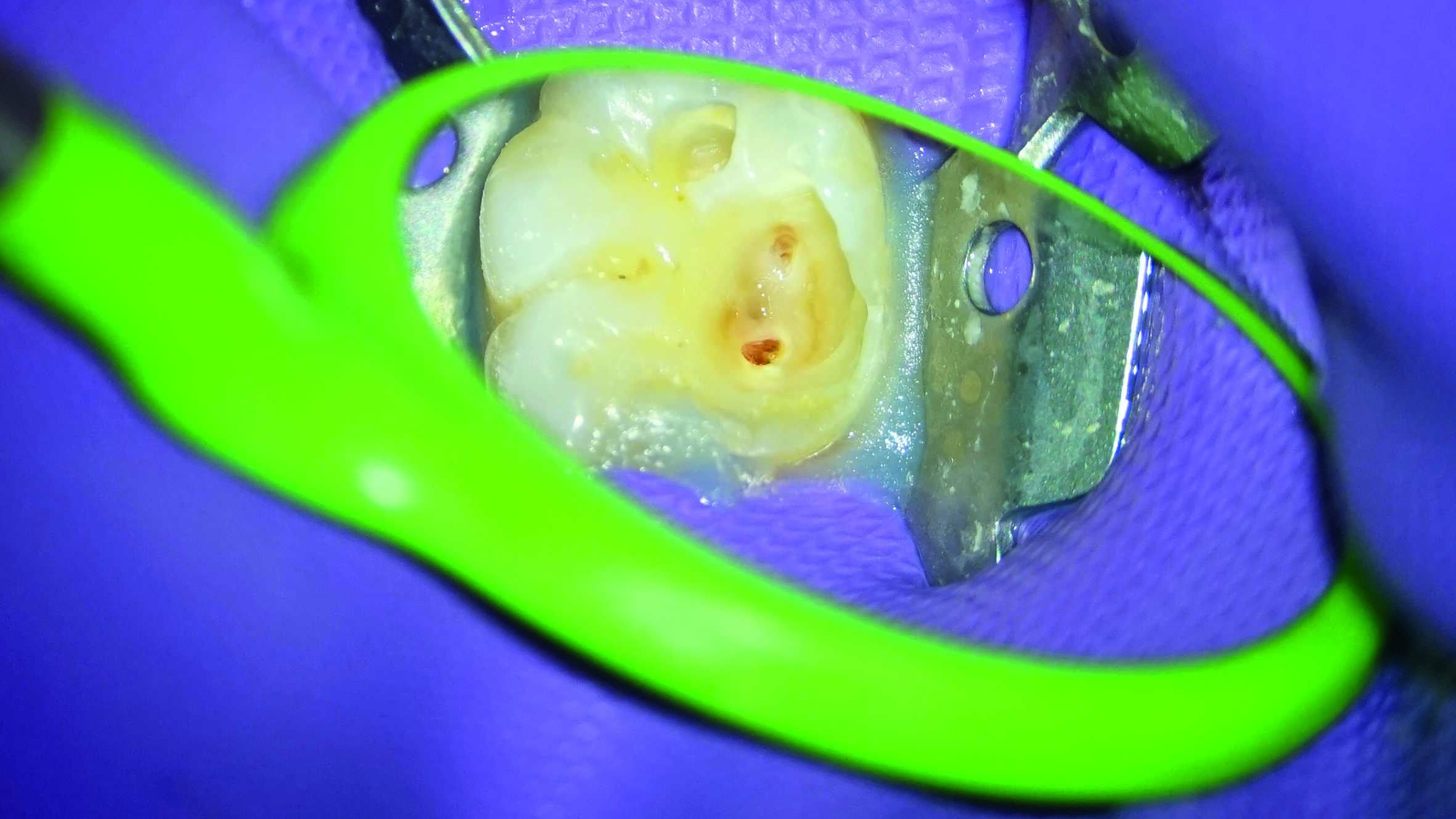 Dental News - Direct pulp capping as a conservative procedure to ...