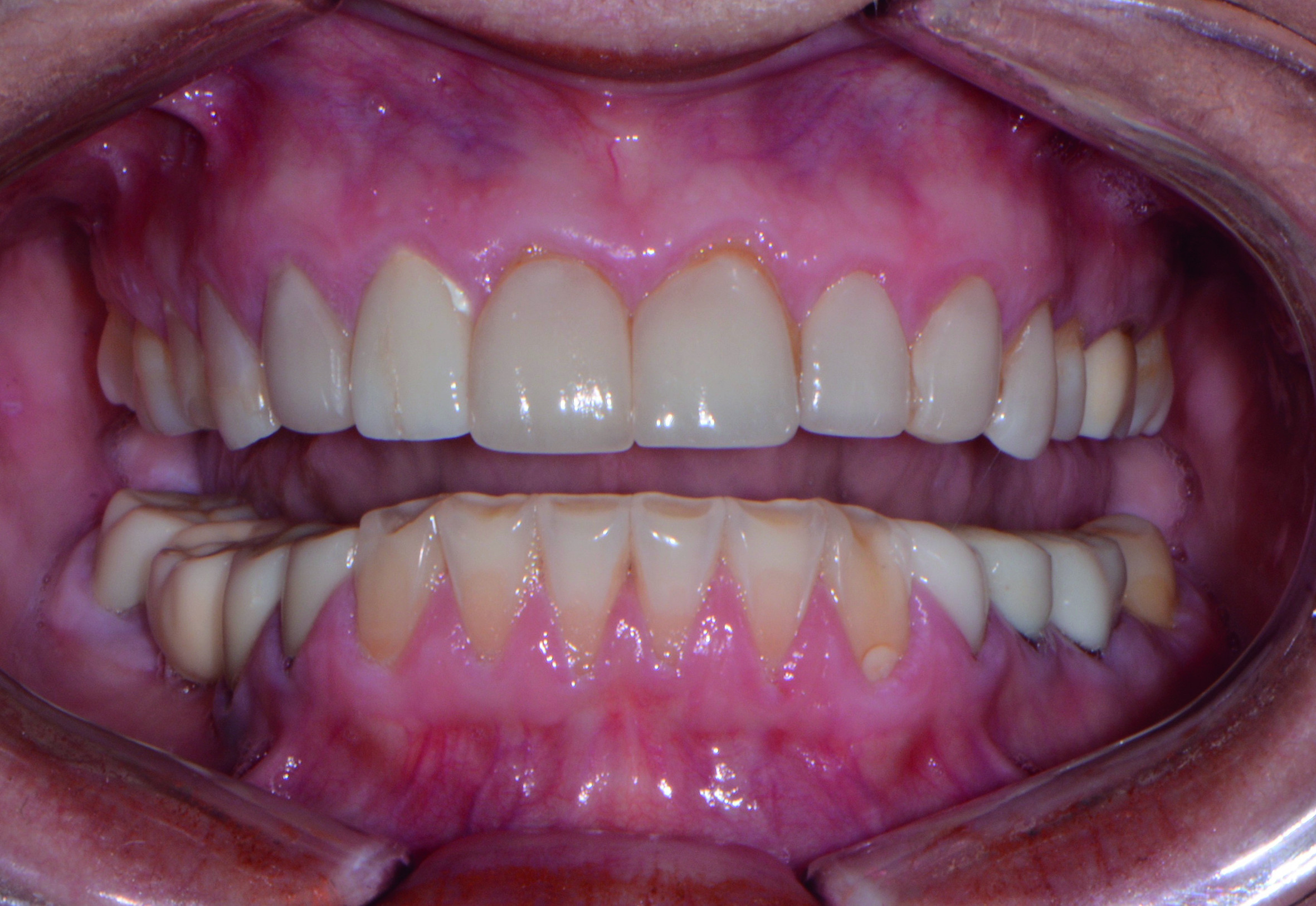 Dental News - Restoring function and aesthetics with monolithic ...