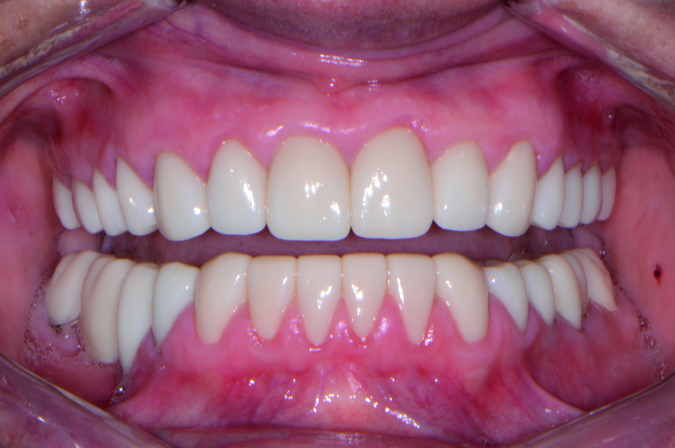 Dental News - Restoring function and aesthetics with monolithic ...