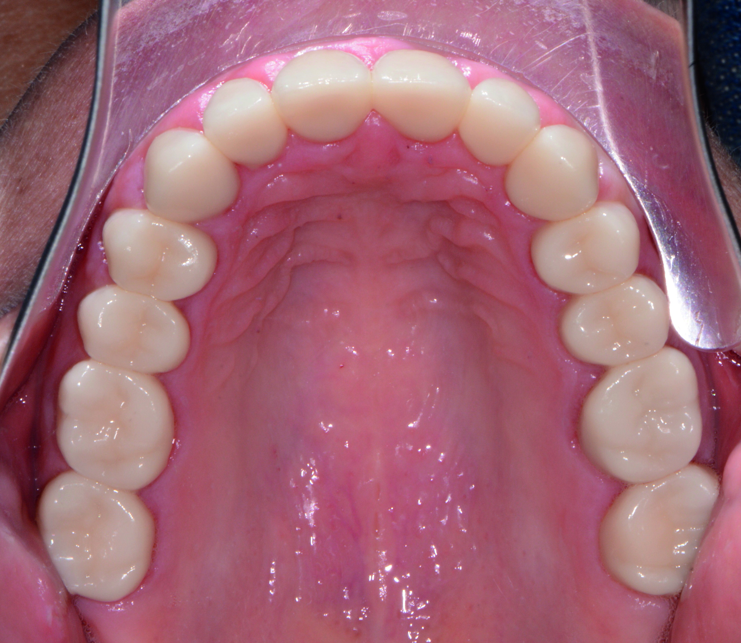 Dental News - Restoring function and aesthetics with monolithic ...