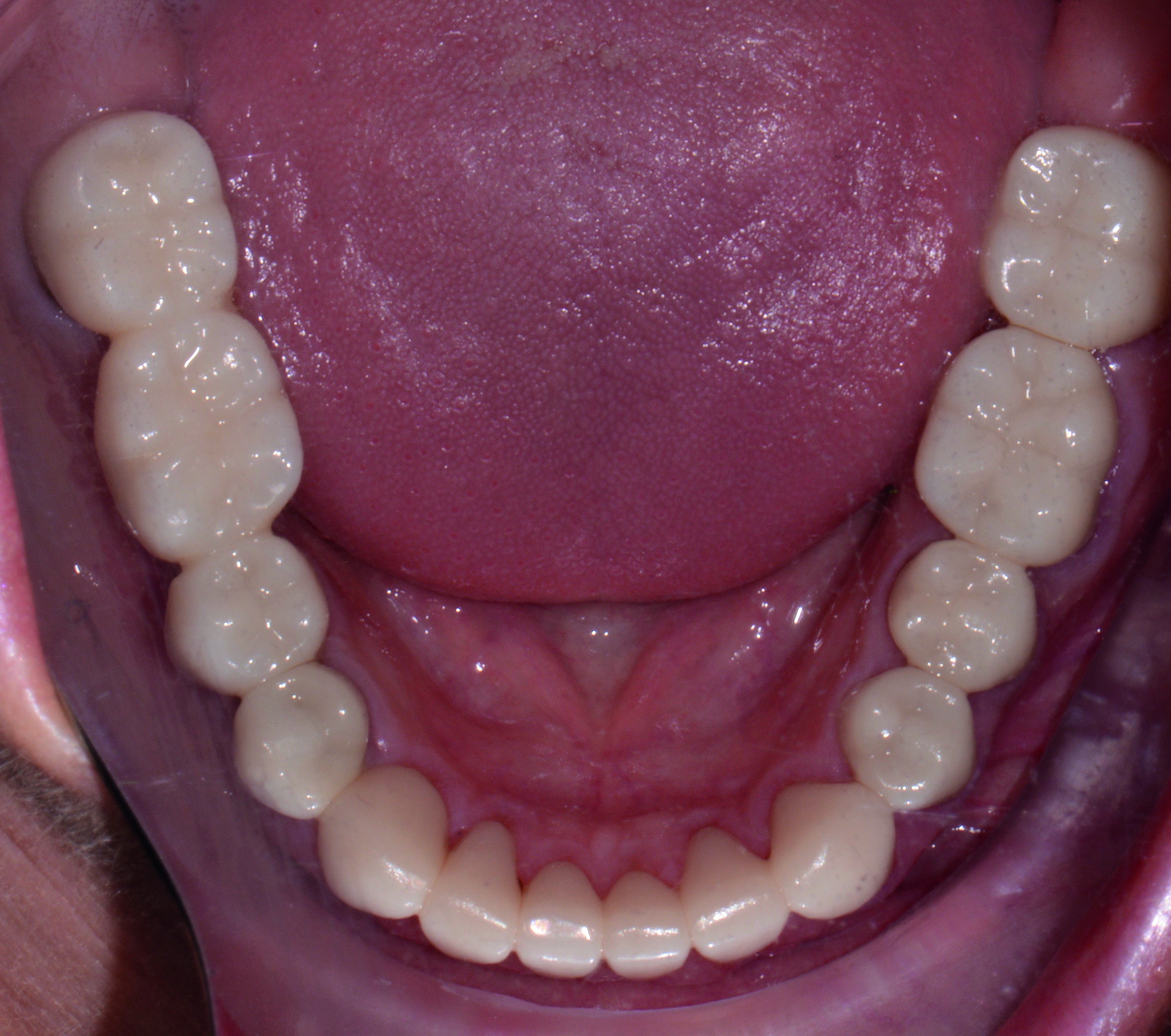 Dental News - Restoring function and aesthetics with monolithic ...