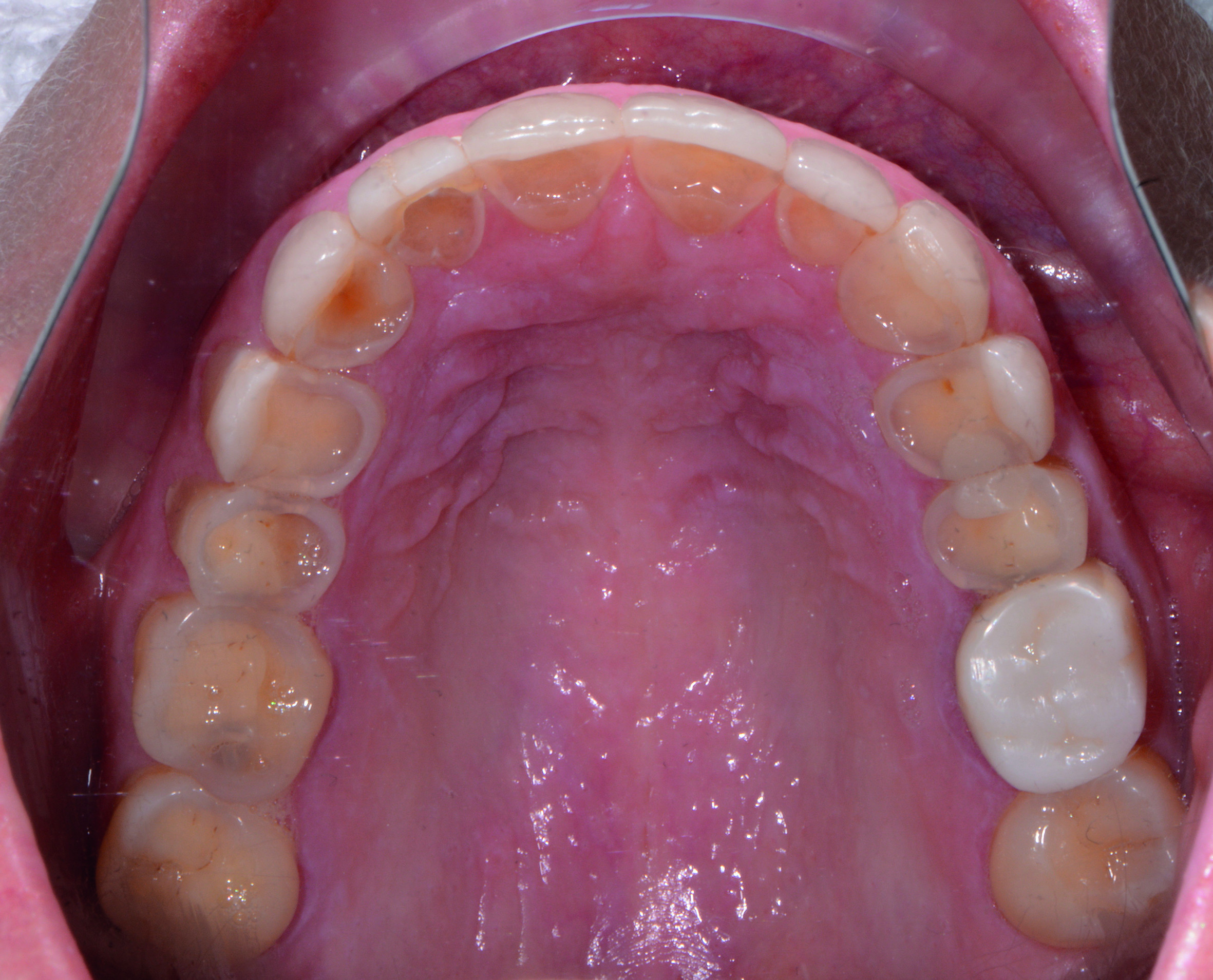 Dental News - Restoring function and aesthetics with monolithic ...