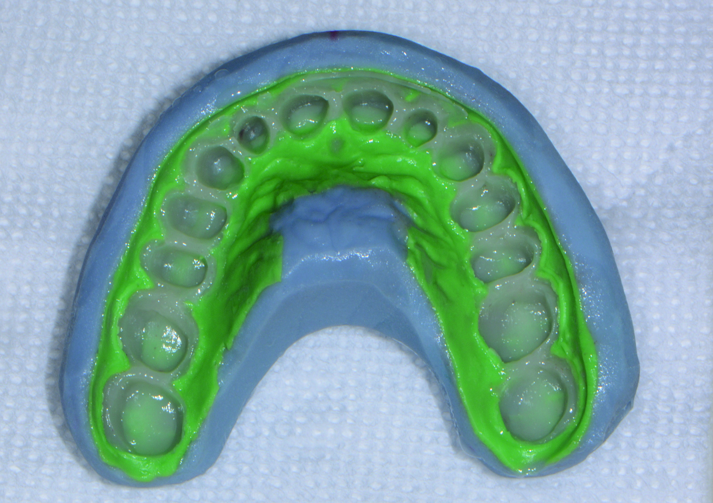 Dental News - Restoring function and aesthetics with monolithic ...