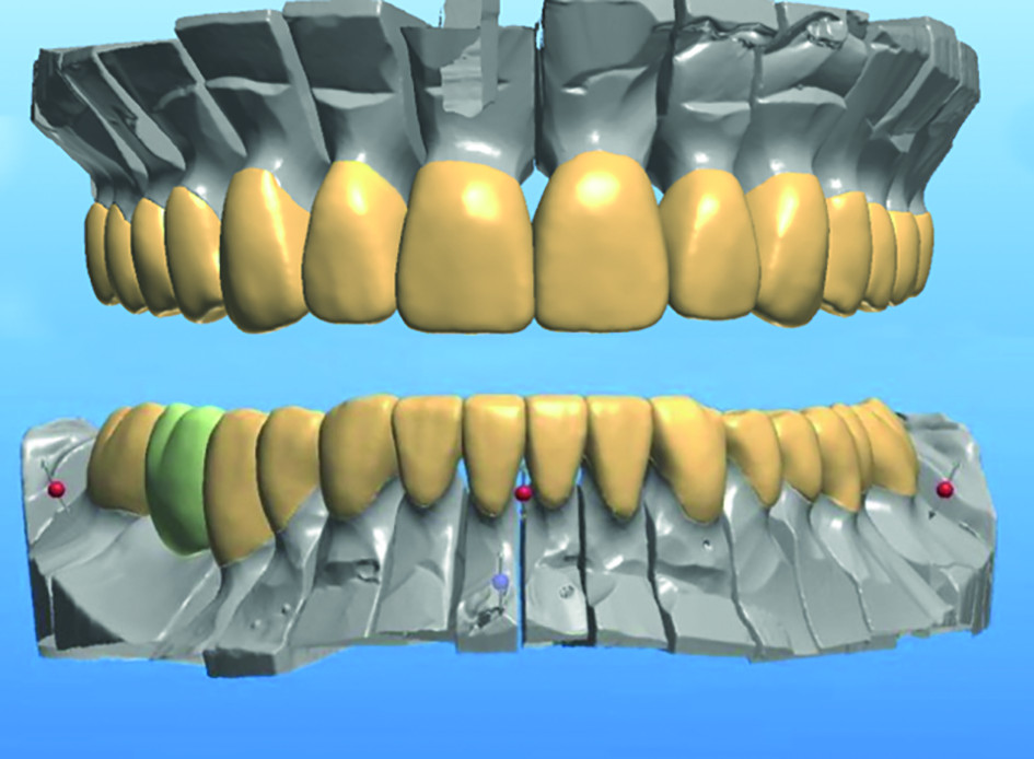 Dental News - Restoring function and aesthetics with monolithic ...