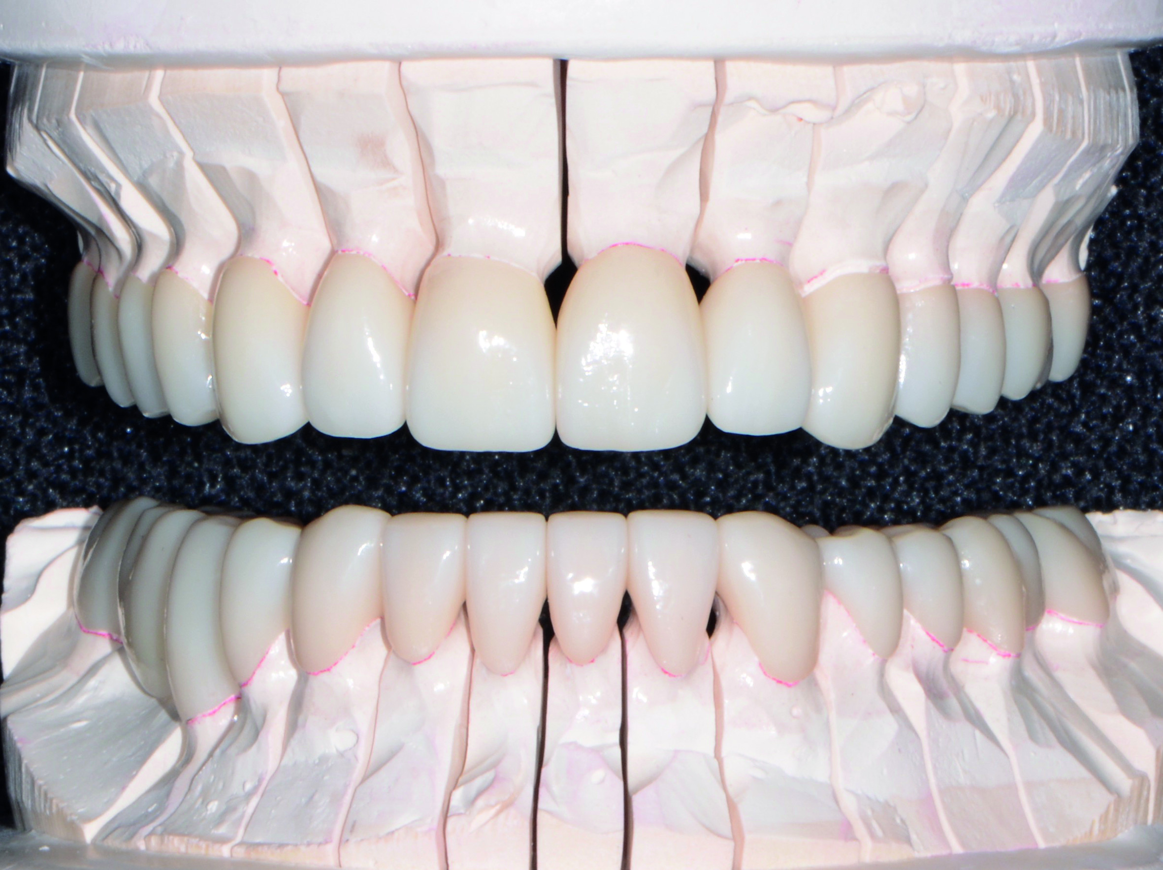Dental News - Restoring function and aesthetics with monolithic ...