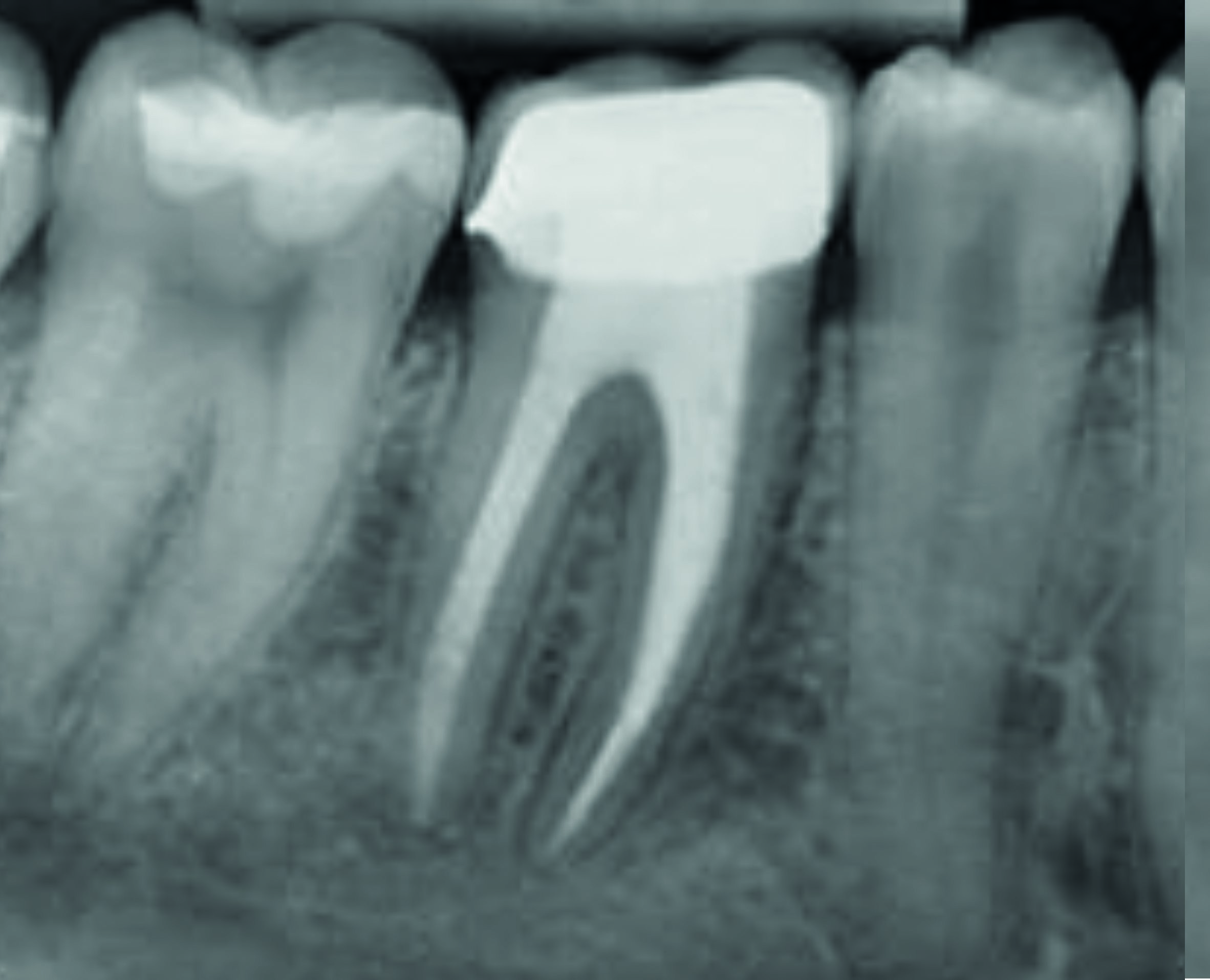 Dental News - Orthograde apical application of an MTA plug in a tooth ...