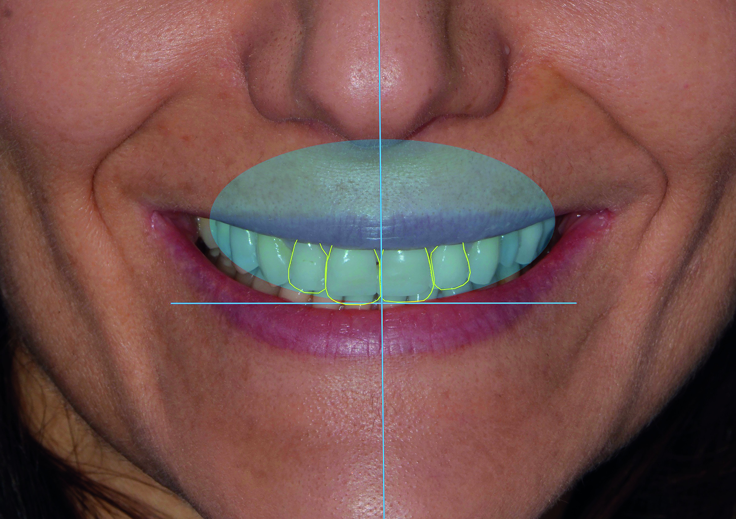 Dental News - Aesthetic Digital Smile Design: 2-D-/3-D-assisted ...