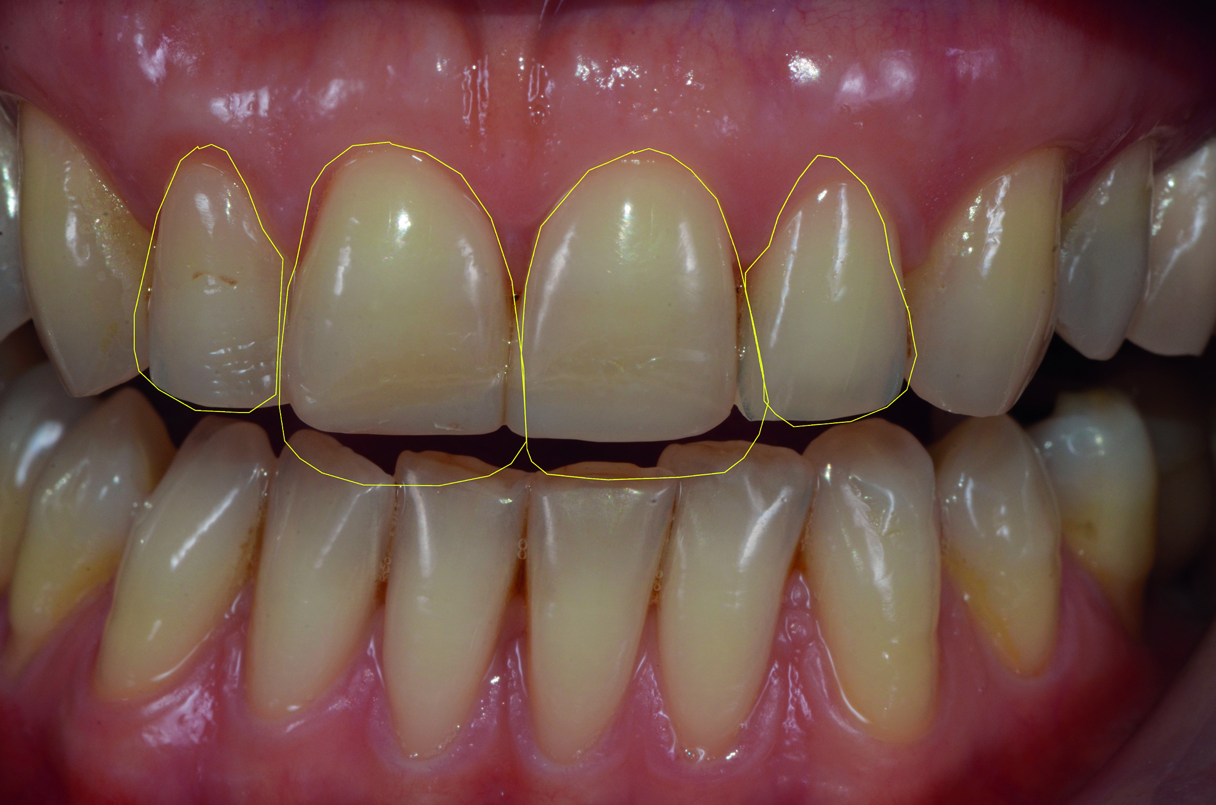 Dental News - Aesthetic Digital Smile Design: 2-D-/3-D-assisted ...