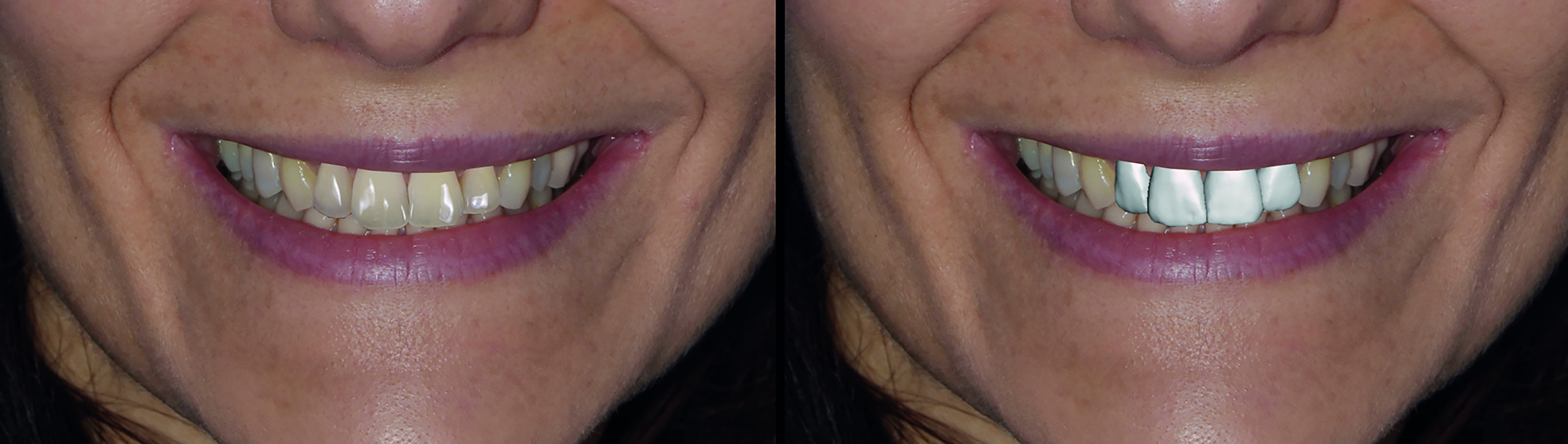 Dental News - Aesthetic Digital Smile Design: 2-D-/3-D-assisted ...