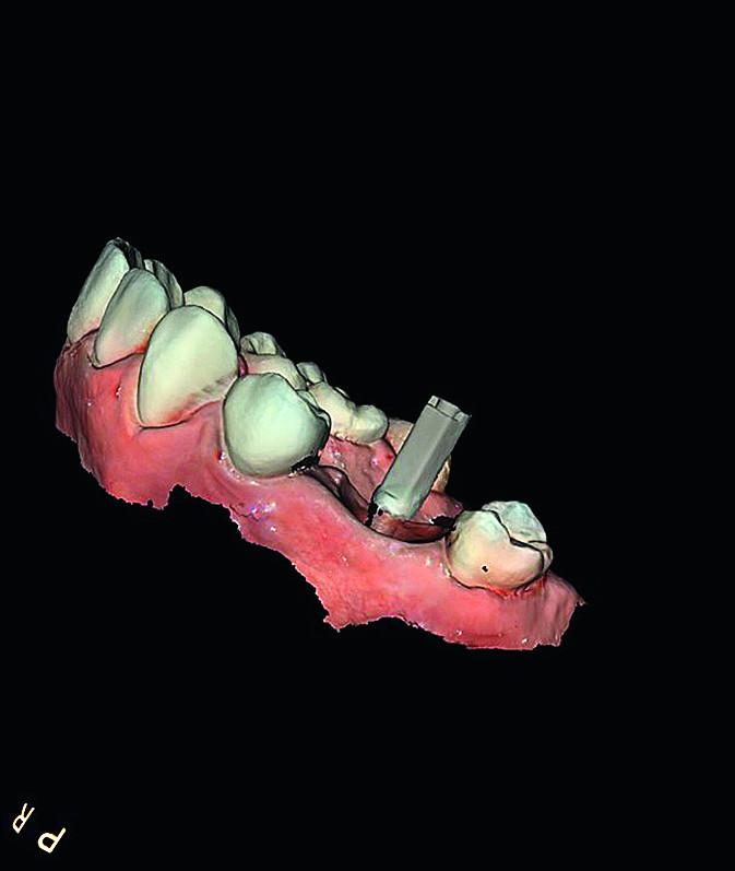 Dental News - Digital workflow and application of PRF and ozone therapy ...
