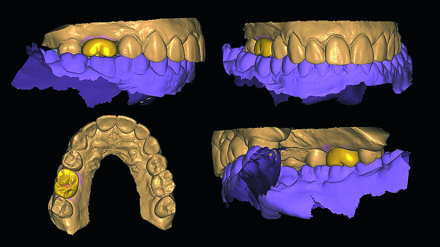 Dental News - Digital workflow and application of PRF and ozone therapy ...