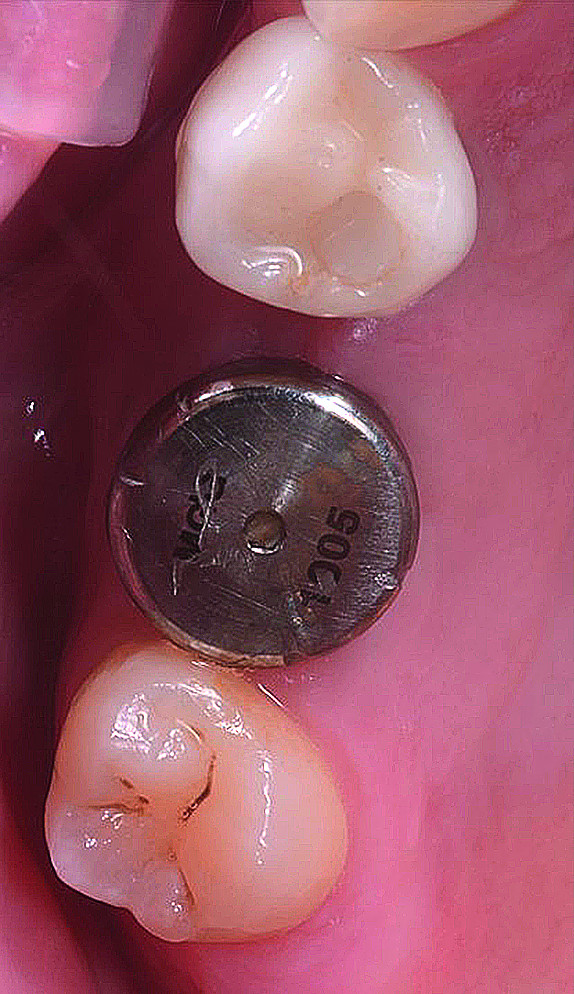 Dental News - Digital workflow and application of PRF and ozone therapy ...