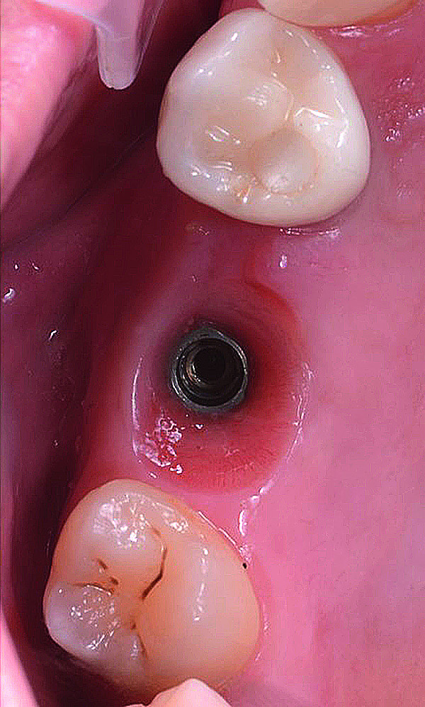 Dental News - Digital workflow and application of PRF and ozone therapy ...