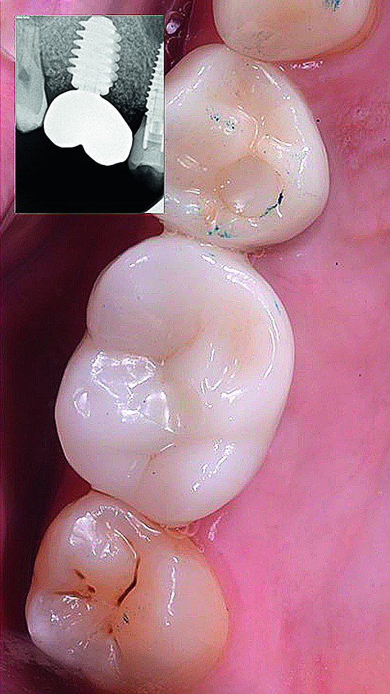 Dental News - Digital workflow and application of PRF and ozone therapy ...